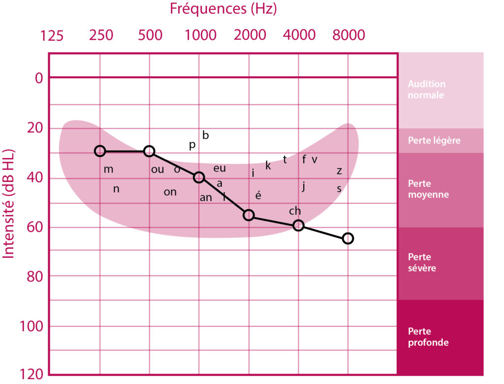Qu’est-ce qu’un audiogramme ? - Gottschalk
